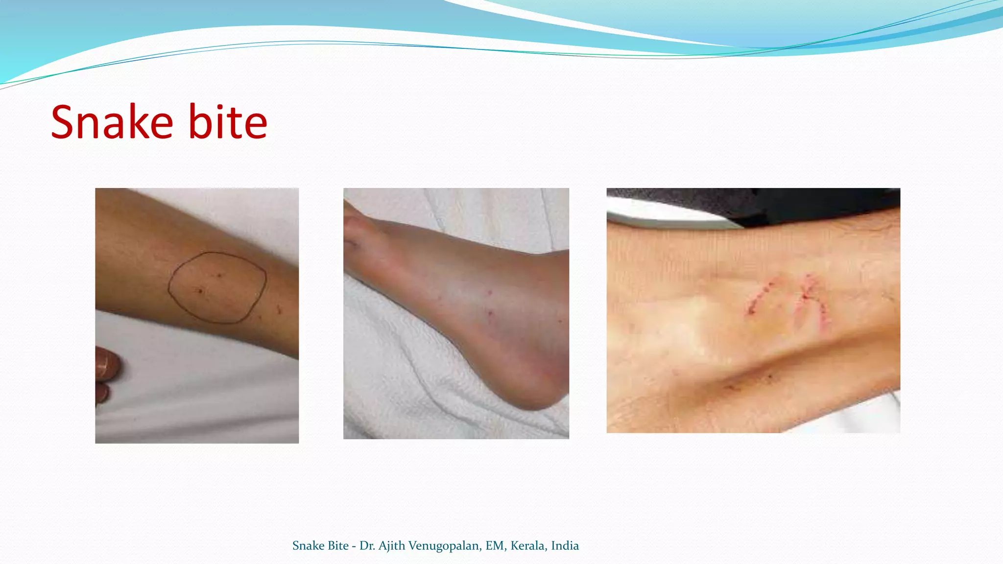 Snake Bite - Evaluation & Management in India - Dr. Ajith Venugopalan ...