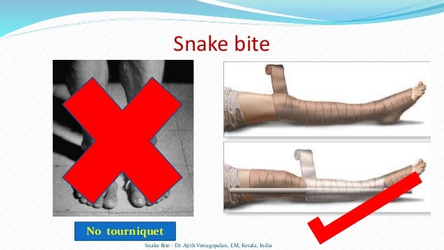 Snake Bite - Evaluation & Management in India - Dr. Ajith Venugopalan…