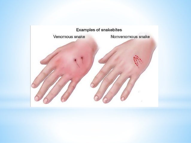 Snake bite and its management