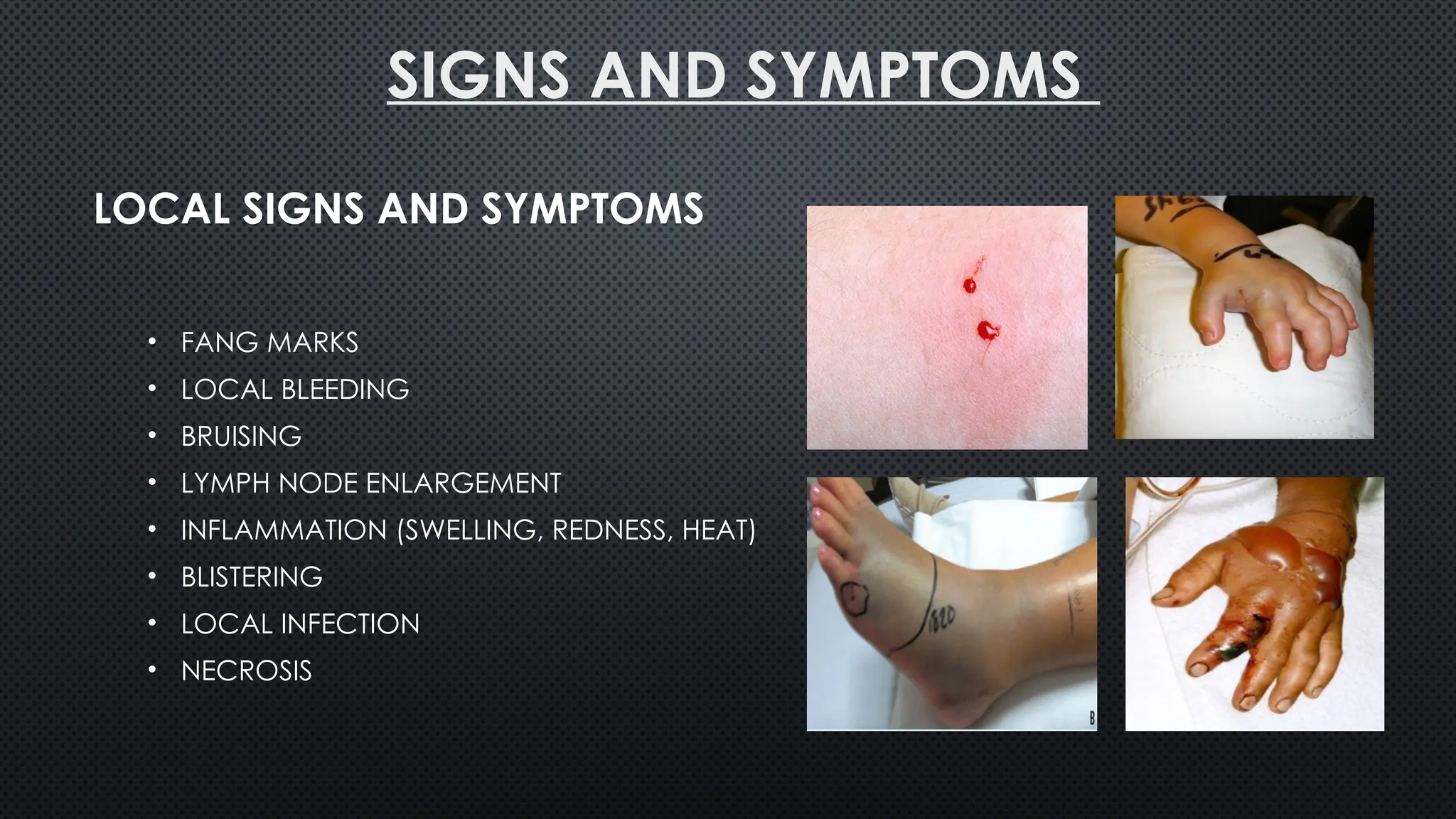 snake bite signs, symptoms and management management .pptx
