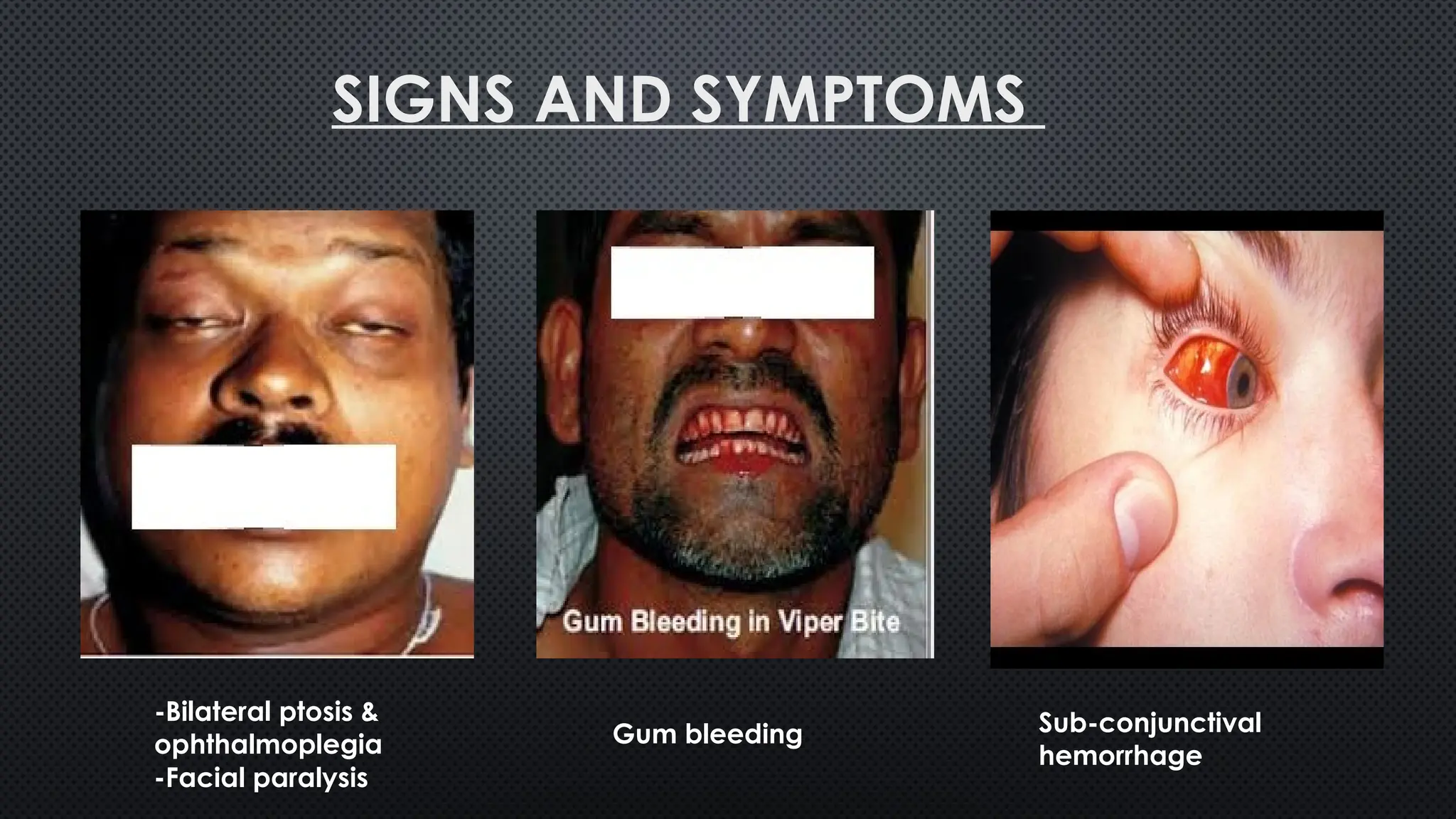 snake bite signs, symptoms and management management .pptx