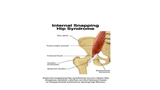 Snapping hip syndrome | PPTX