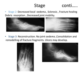 charcot disease. | PPTX