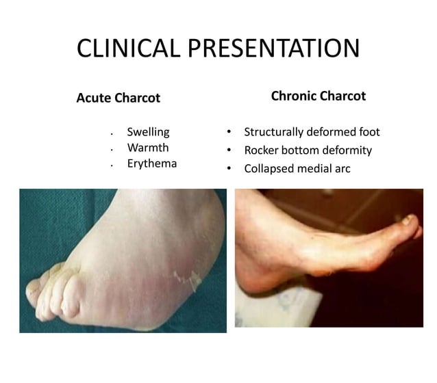 charcot disease. | PPTX | Bone and Joint Conditions | Diseases and ...
