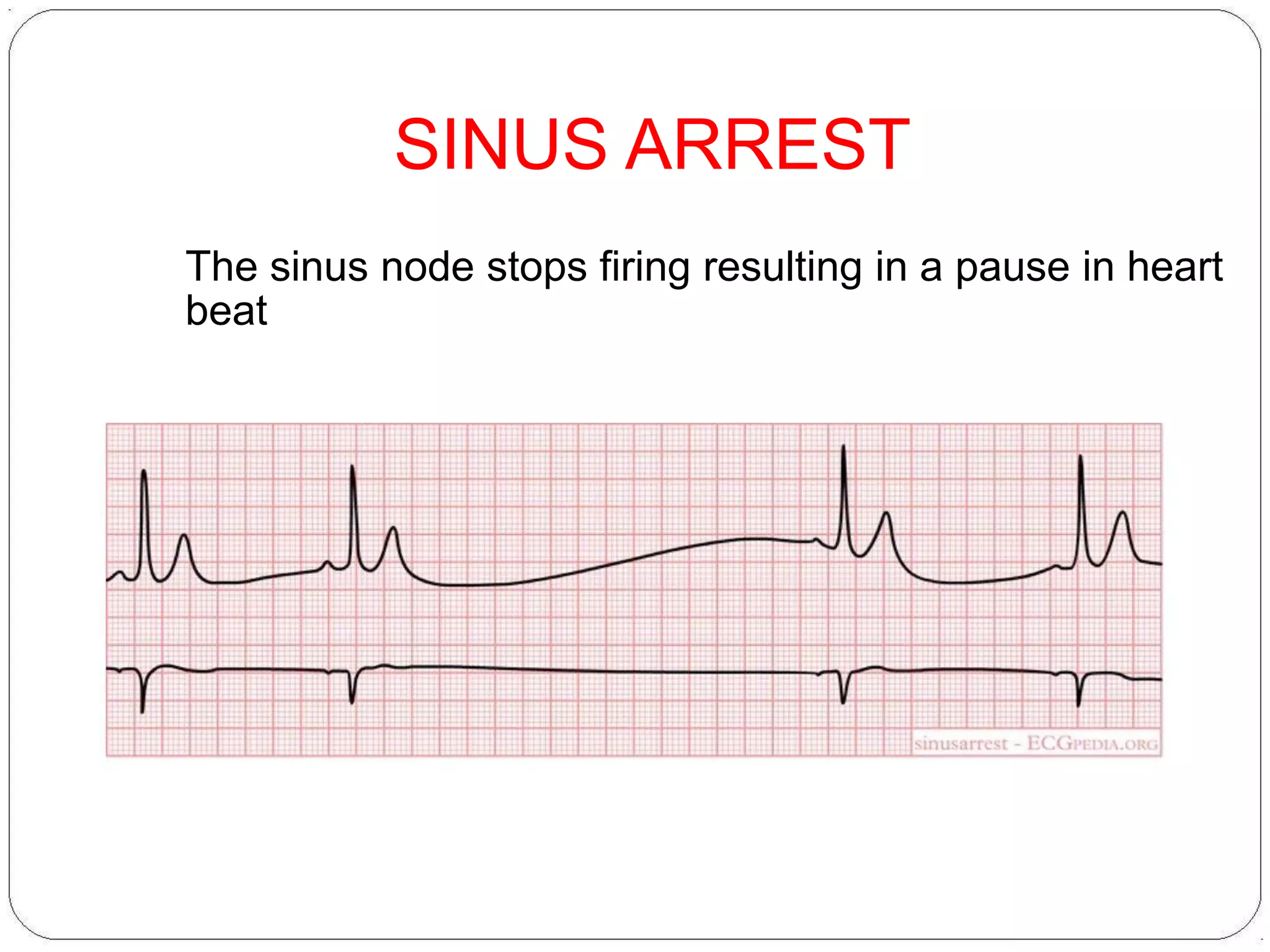 Sinus Node Dysfunction Pptx