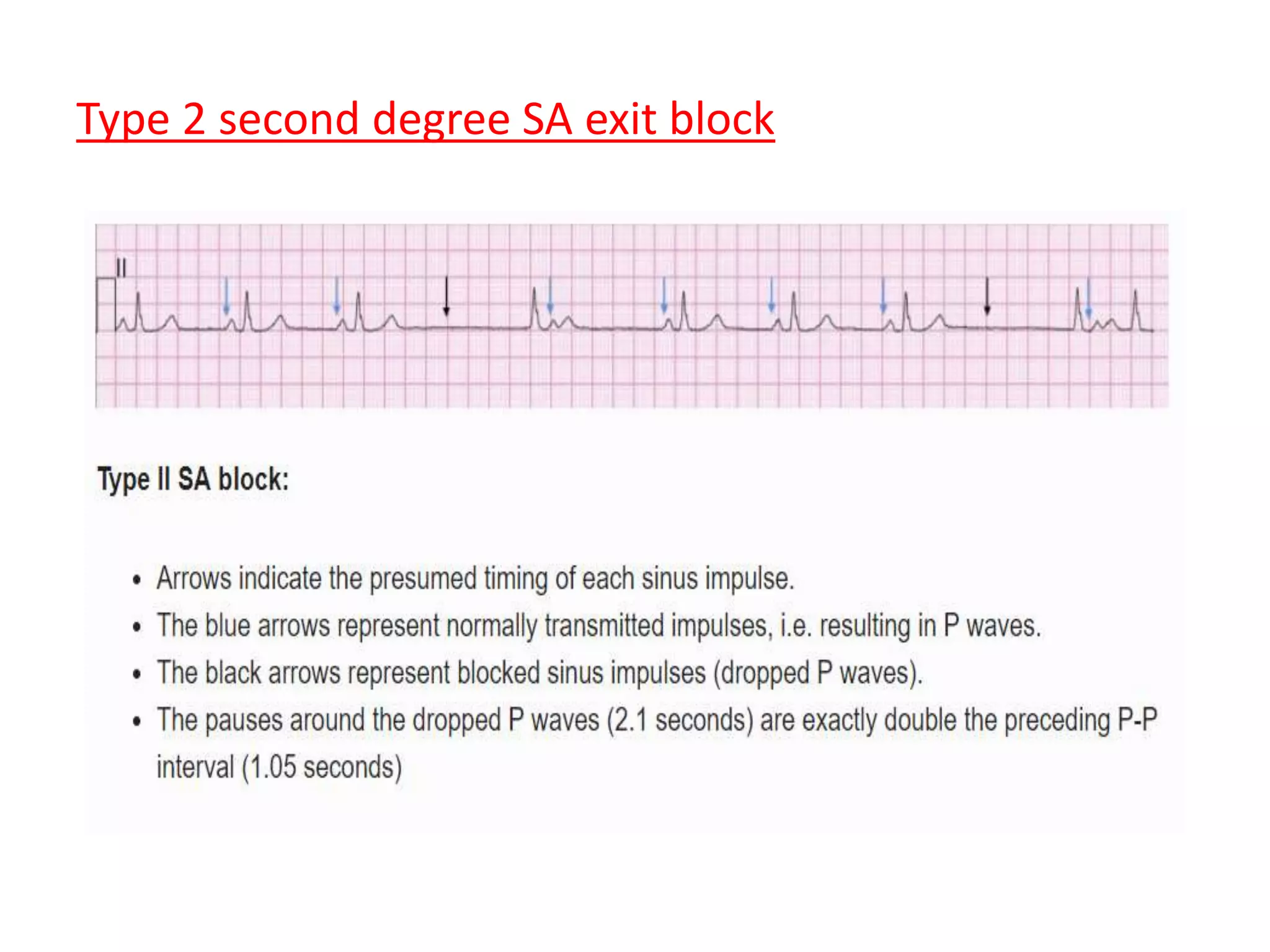 Sinus Node Dysfunction Pptx