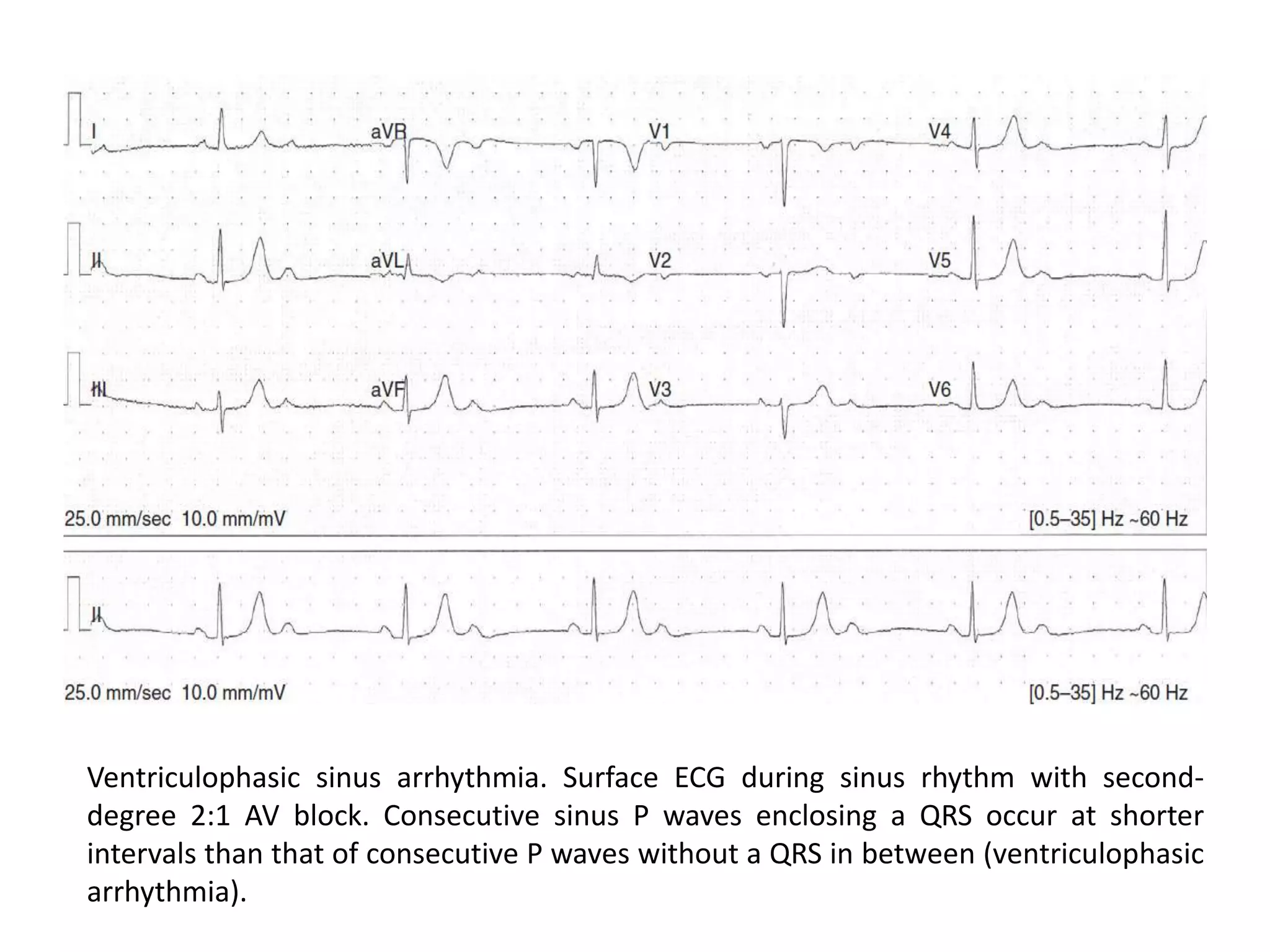 Sinus Node Dysfunction Pptx