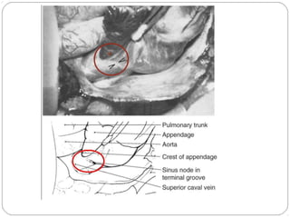 Sinus Node Dysfunction | PPTX