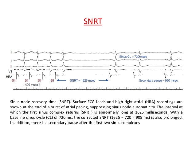 Sinus Node Dysfunction