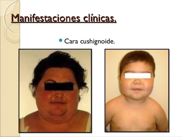 Síndrome de cushing