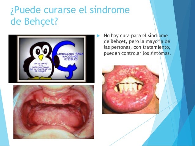 Síndrome de-behçet