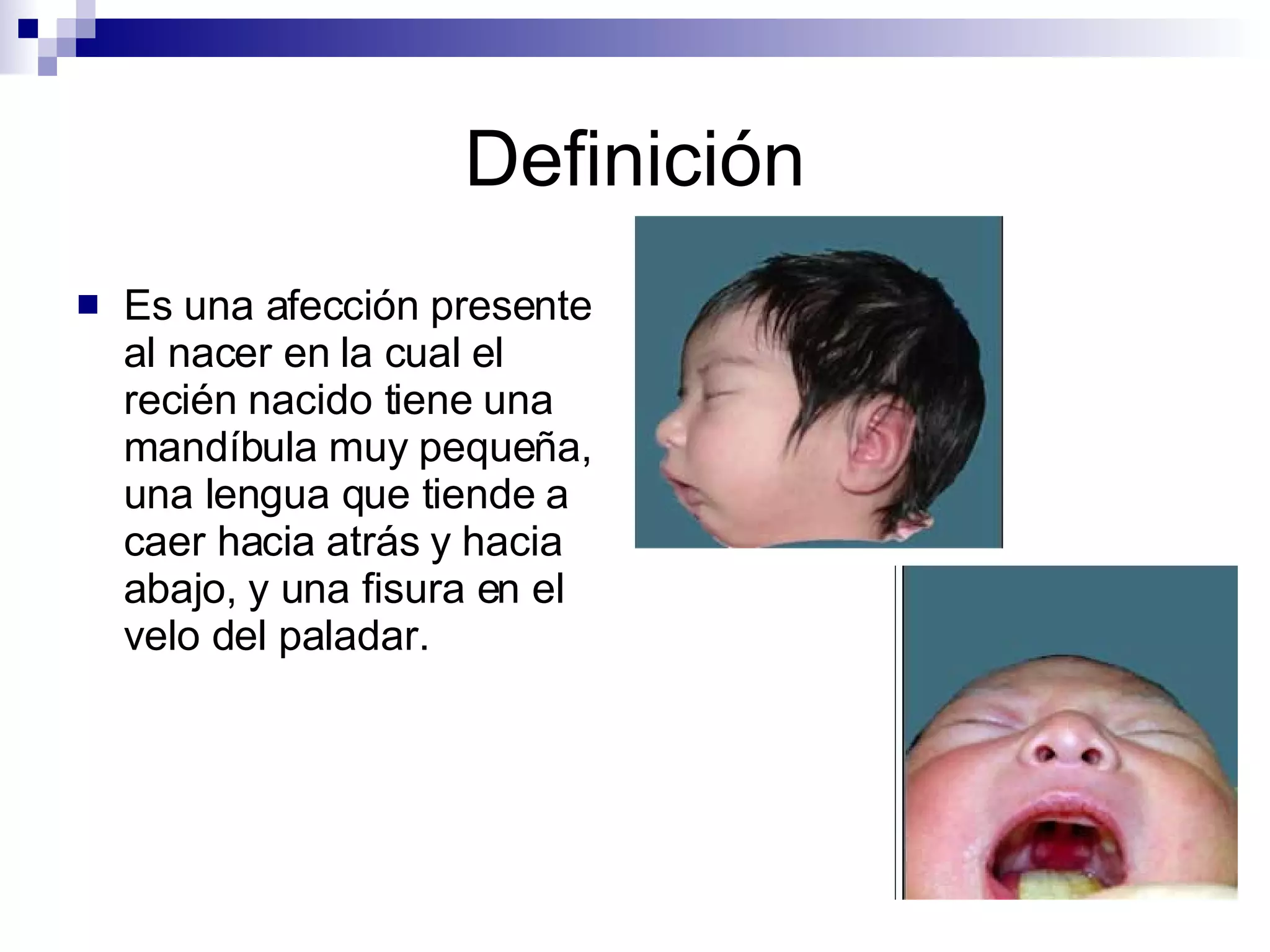 Síndrome de Pierre Robin | PPT