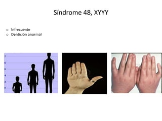 Síndrome 47, xxx | PPTX