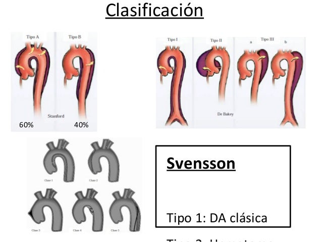 Sesión 12 de Abril: Síndrome aórtico agudo