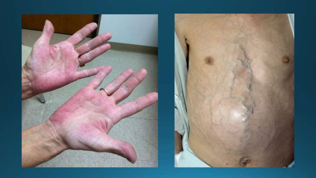 Síndrome ascítico edematoso