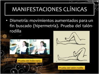 Semiología del Síndrome cerebeloso | PPTX