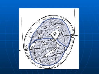 Síndrome Compartimental | PPT