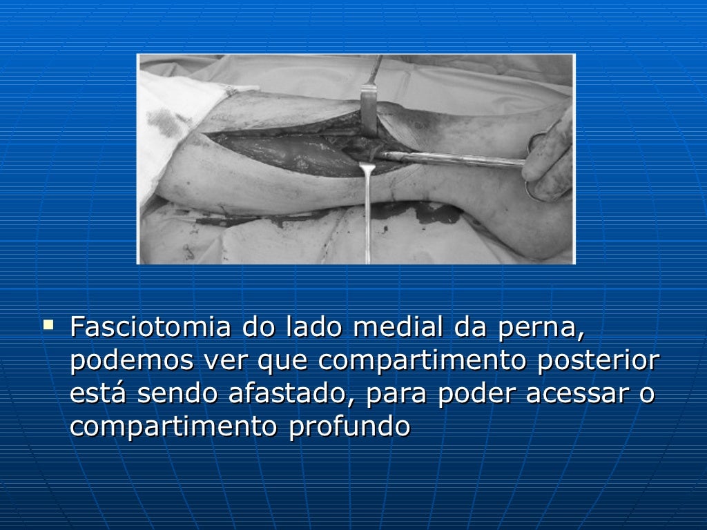 Síndrome Compartimental