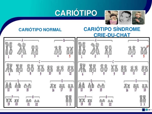 Síndrome cri du-chat