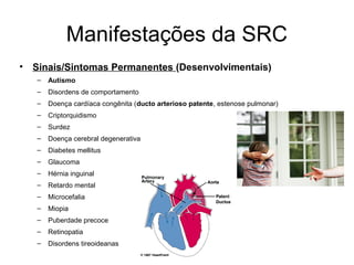 Síndrome da rubéola congênita | PPT
