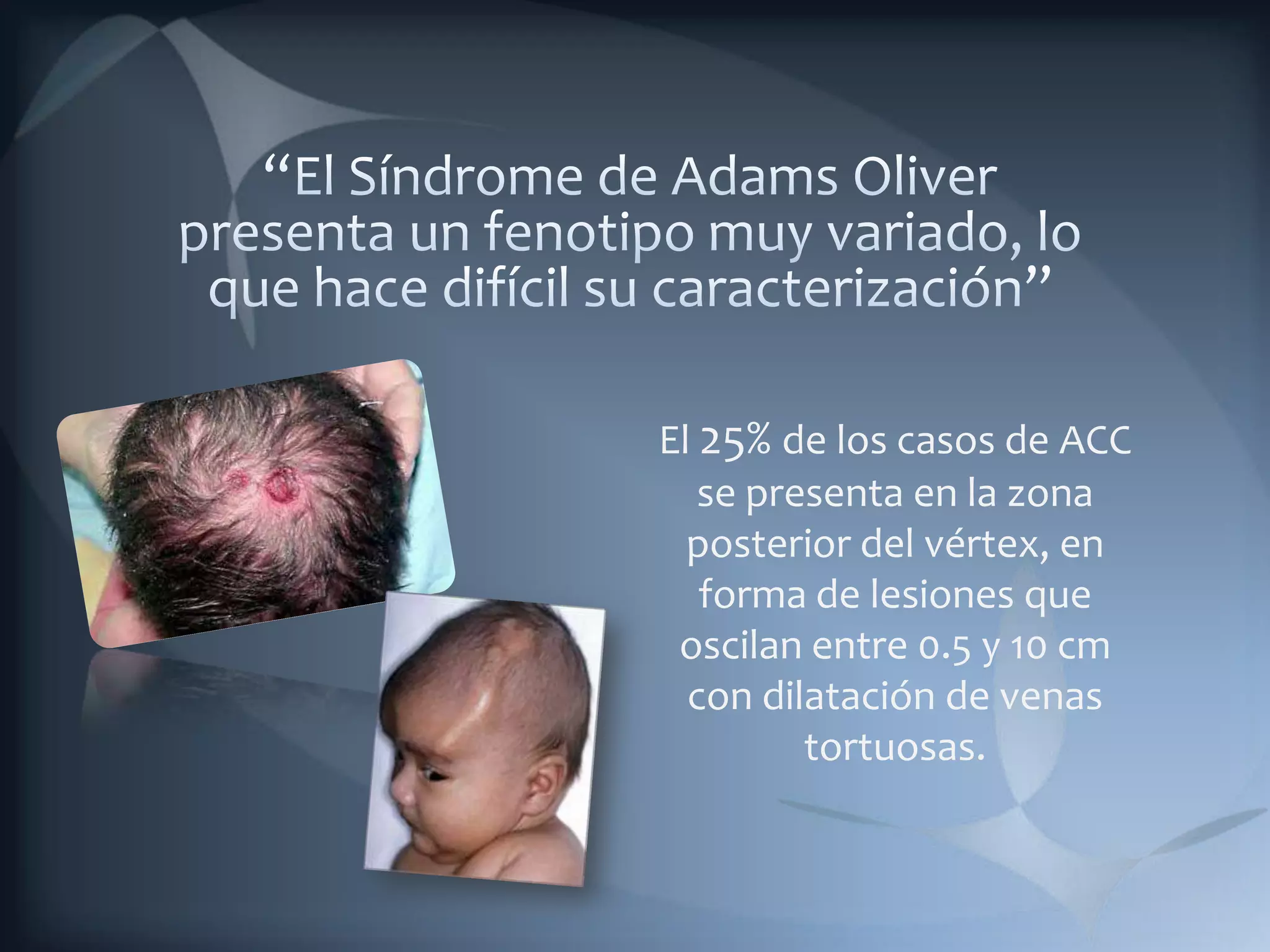 SÍNDROME DE ADAMS OLIVER | PPTX