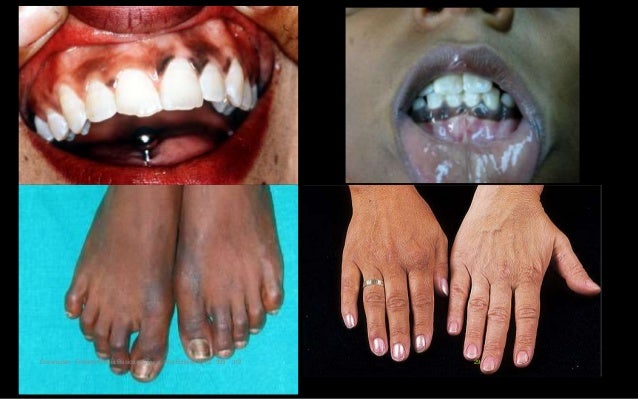 Enfermedad de Addison