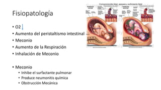 Síndrome de Aspiración de Meconio (SAM) | PDF