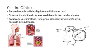 Síndrome de Aspiración de Meconio (SAM) | PDF