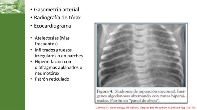 Síndrome de aspiración de meconio