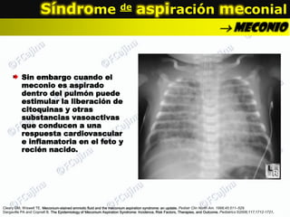 Síndrome de aspiración meconial | PDF