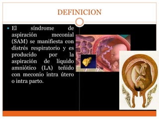 Síndrome de aspiración meconial | PPTX