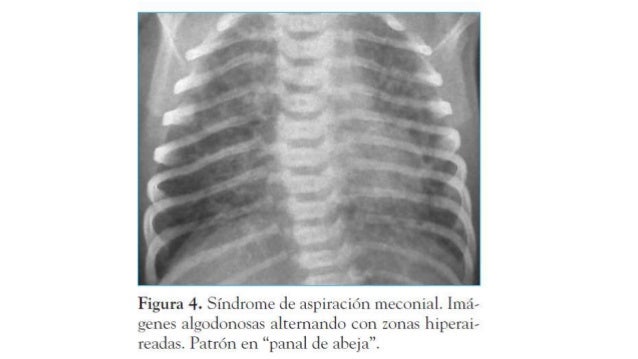 Síndrome de aspiración meconial