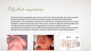 Síndrome de aspiración meconial | PPTX