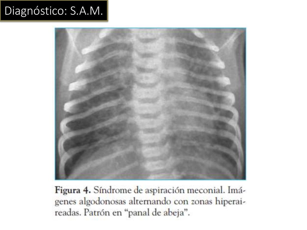 Síndrome de aspiracion de meconio
