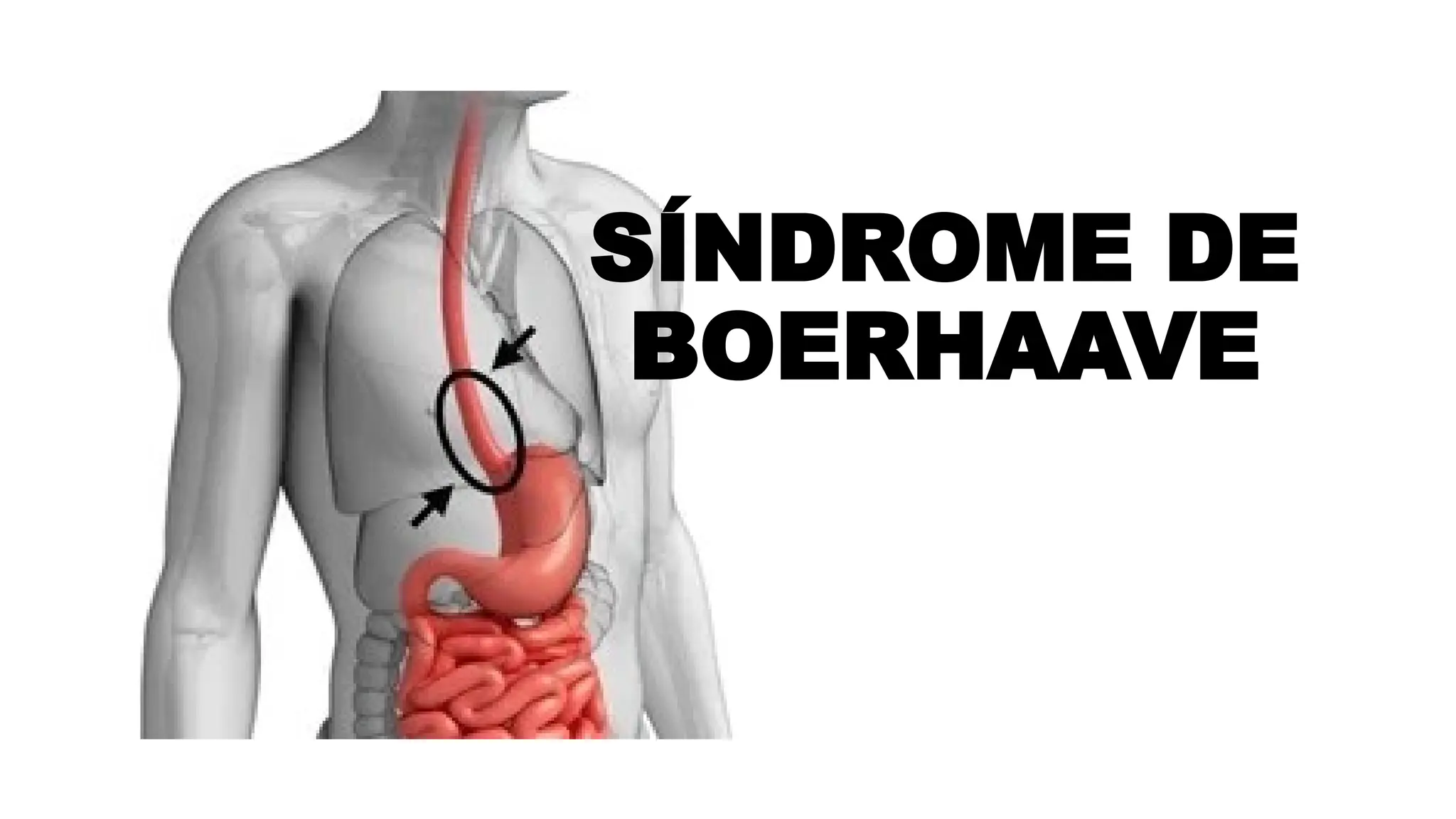 SÍNDROME DE BOERHAAVE GASTROENTEROLOGIA.pptx