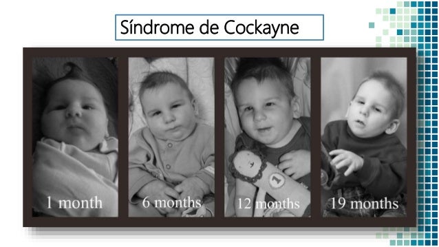 Síndrome de Cockayne (Genética)