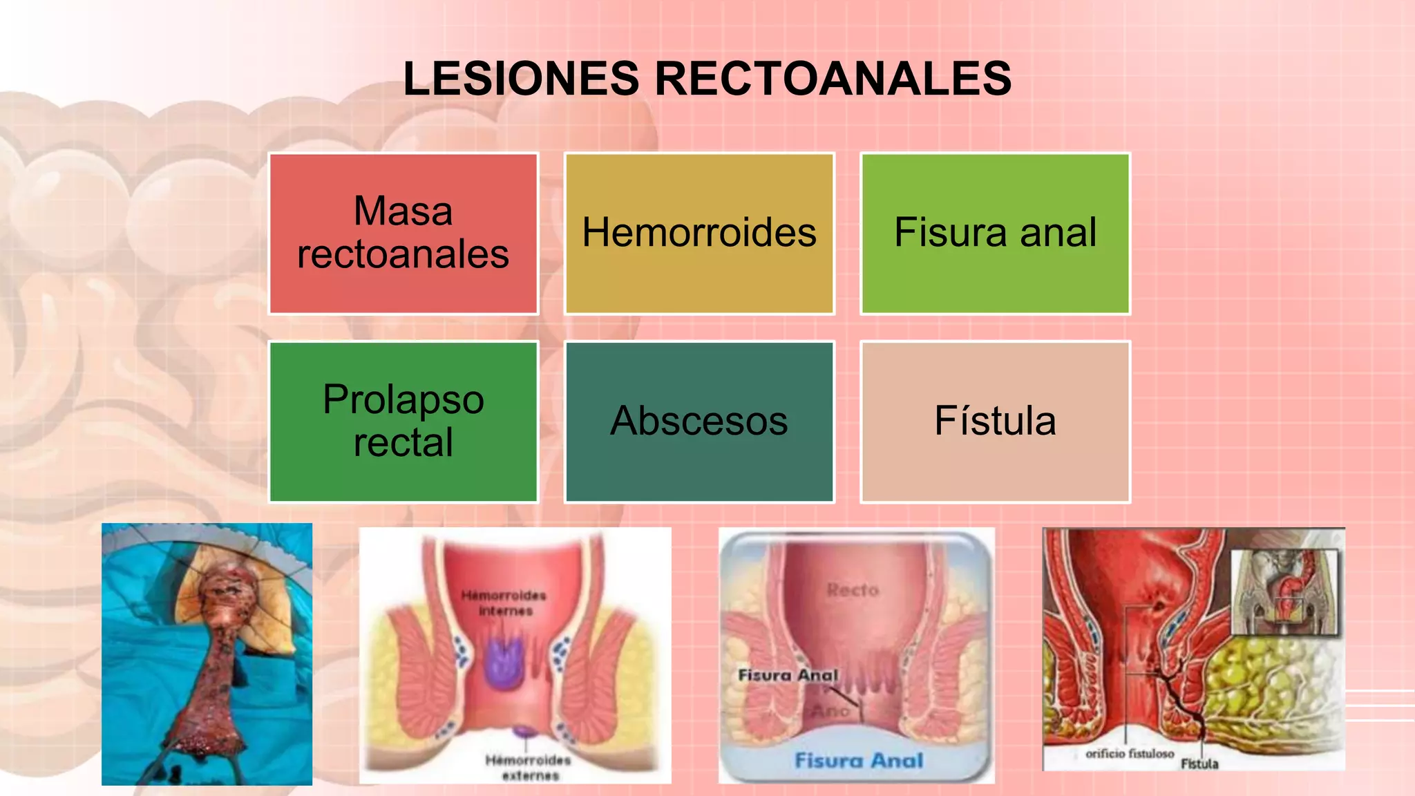SÍNDROME DE COLON IRRITABLE Y RECTOANALES | PPT