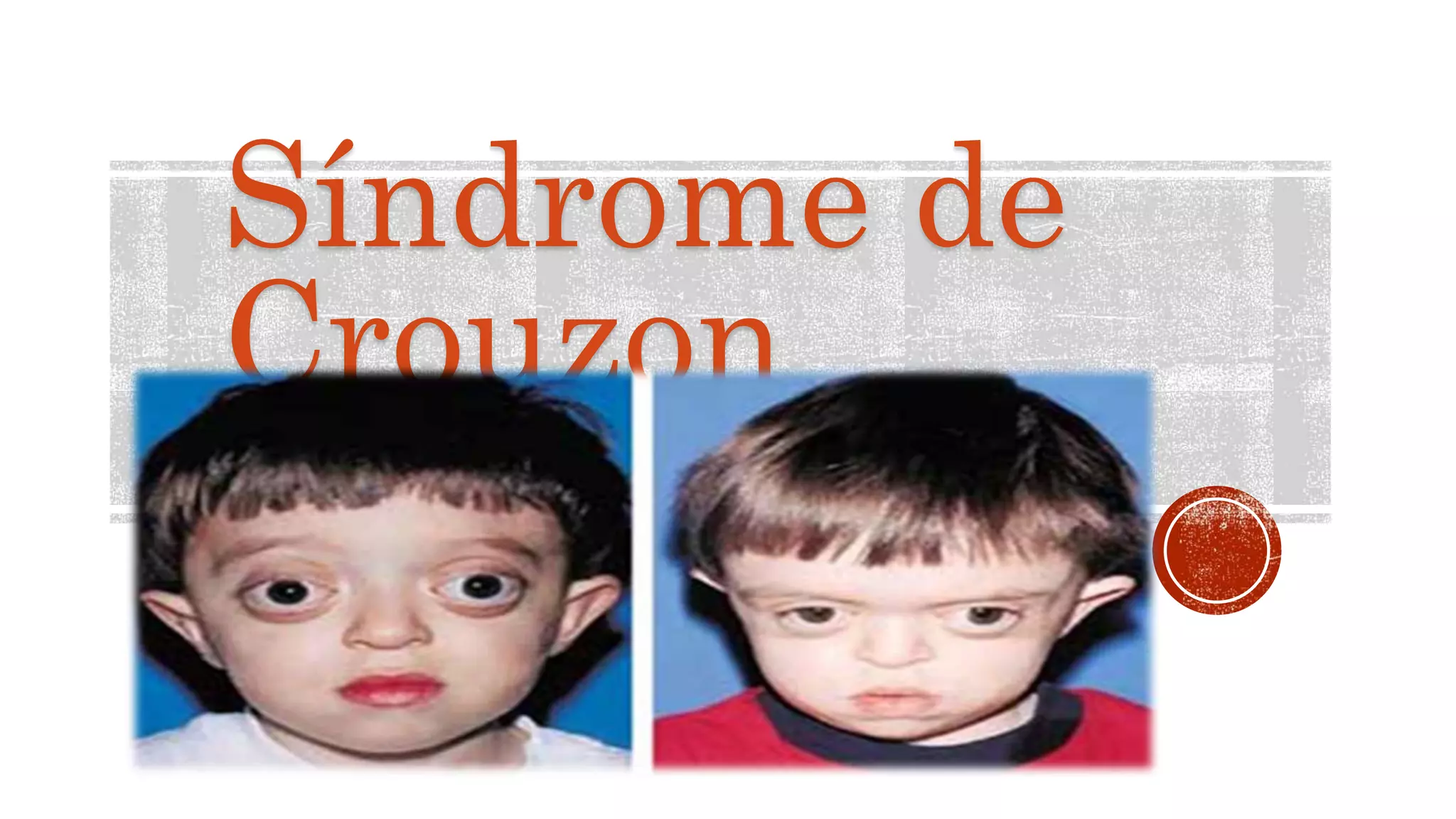 Síndrome de crouzon | PPT