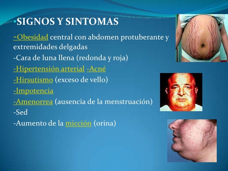 Síndrome de cushing expo orto