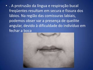 Síndrome de down e a Odontologia | PPTX