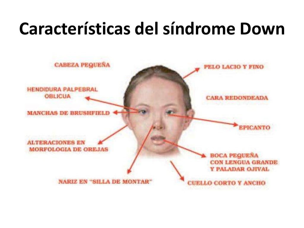 Sã­ndrome de down o trisomia 21 presentacion