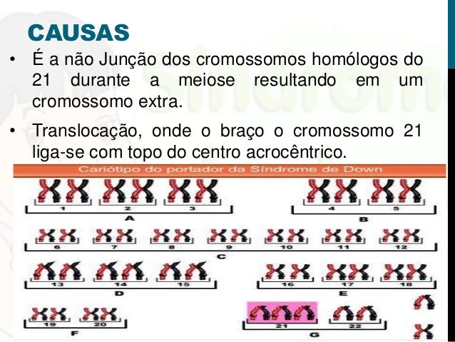 Síndrome de down ou trissomia do cromossoma 21