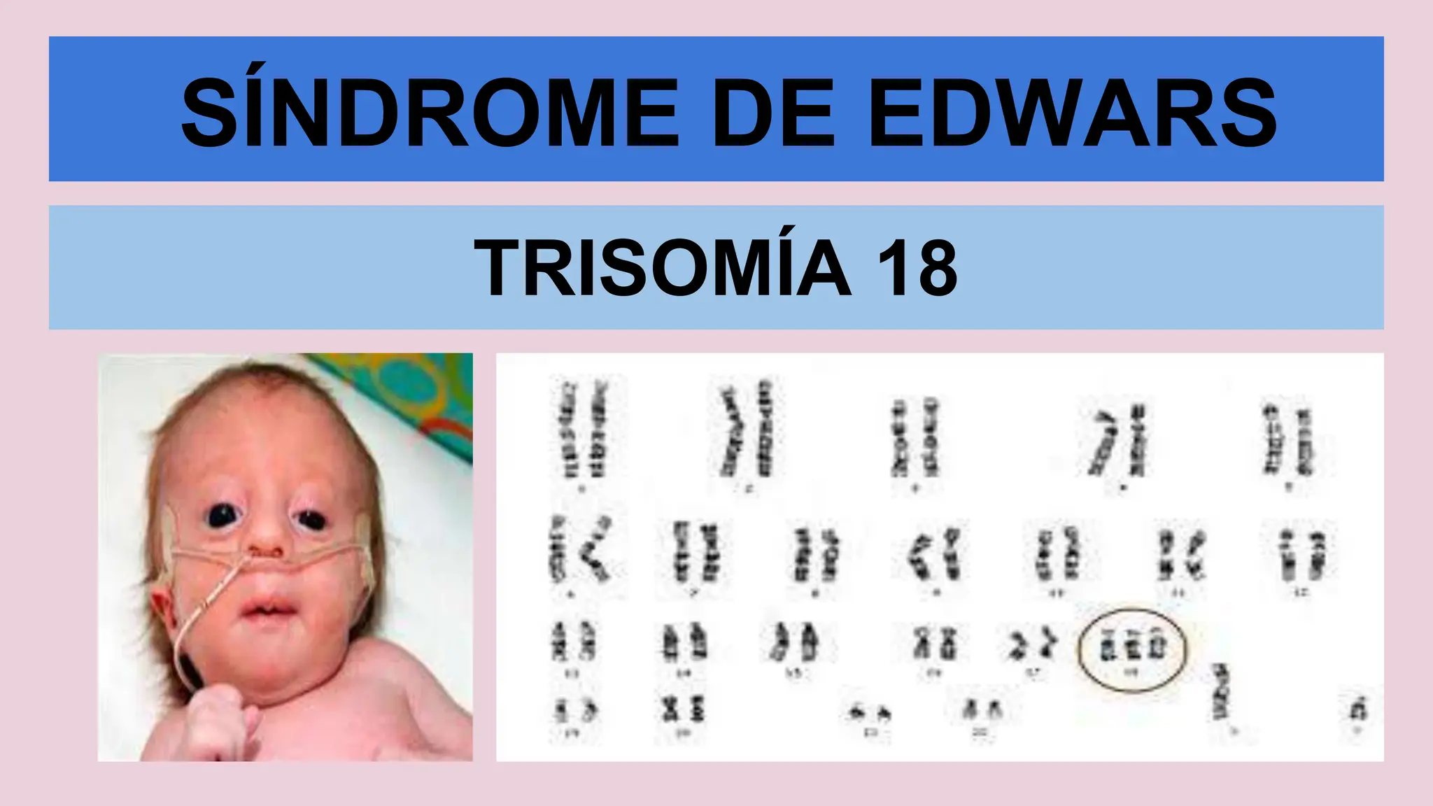 SÍNDROME DE EDWARDS_TRISOMIA 18 (1).pptx