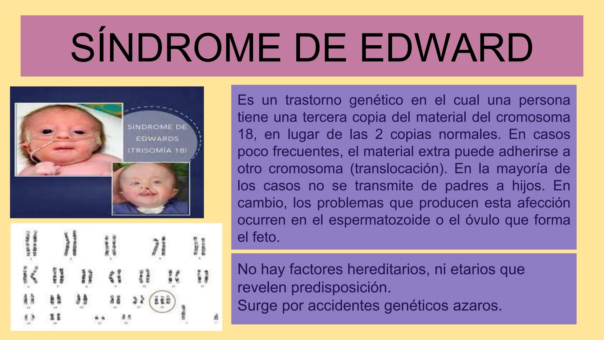 SÍNDROME DE EDWARDS_TRISOMIA 18 (1).pptx