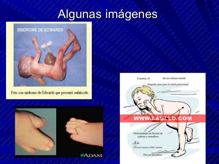 Síndrome de Edwards