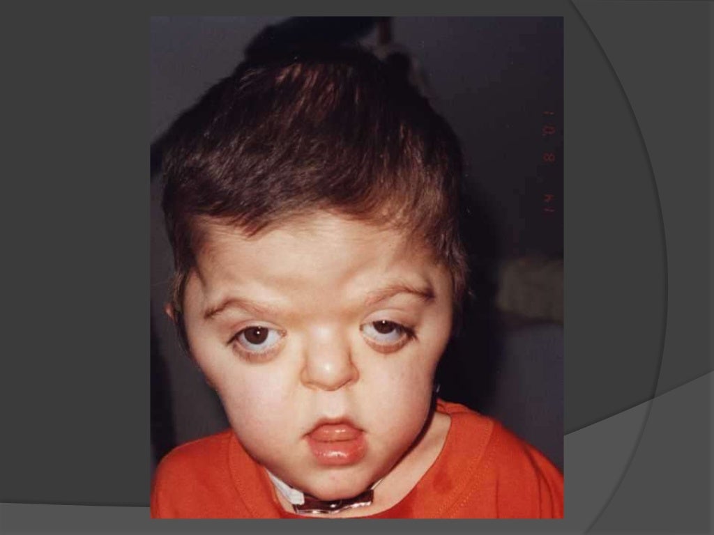 Síndrome de edwards