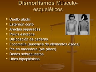 Síndrome de edwards | PPT