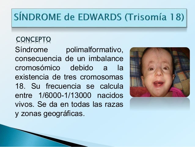 ¿Qué Es Y Cómo Se Trata El Síndrome De Edwards? – HHCT