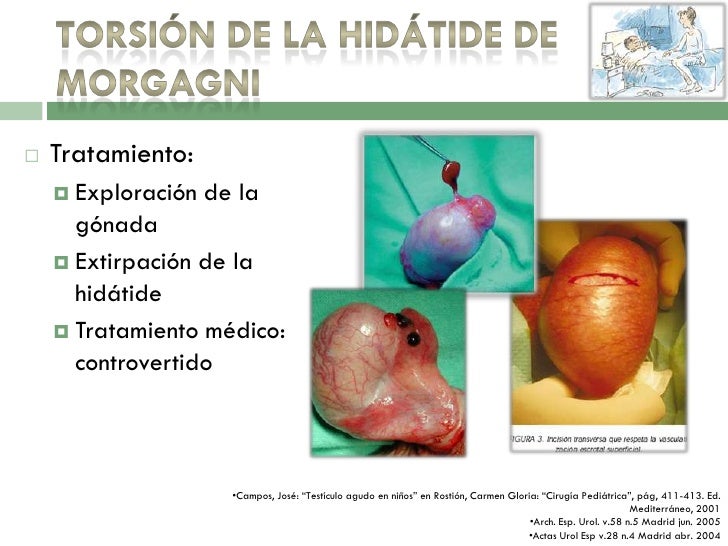 Síndrome de escroto agudo