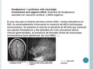 Síndrome de goodpasture jennifer delgadillo | PPTX